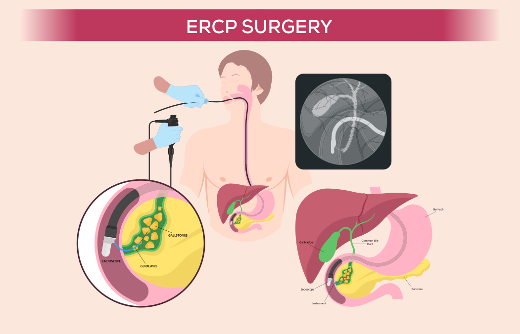 Why is ERCP Necessary?