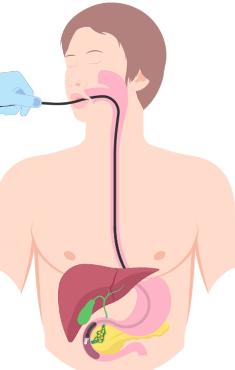 What is ERCP Surgery?