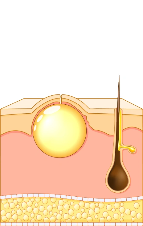 Safe Sebaceous Cyst Removal Surgery in Hyderabad, India