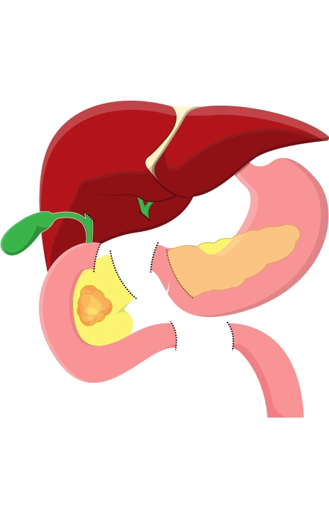 Top Whipple Surgery in Hyderabad, India